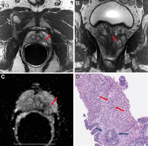 Mesenchymal Neoplasms Of The Prostate And Seminal Vesicles Spectrum Of