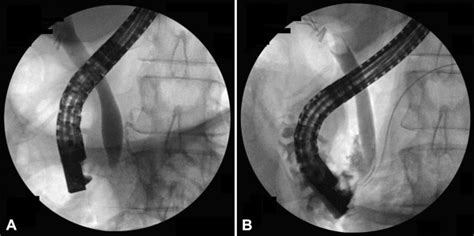 Algorithm For The Management Of Ercp Related Perforations Gastrointestinal Endoscopy