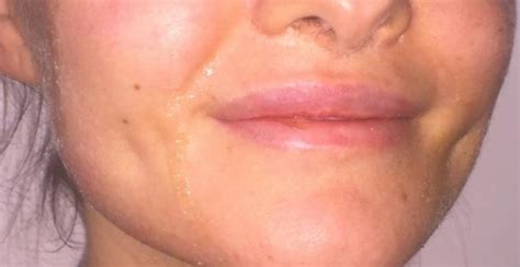 Cheek Dimple Cheek Implant Photos Plastic Surgeon Doctor