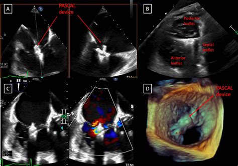 Example Of Echocardiographic Guidance Of Edge To Edge Repair For Download Scientific Diagram