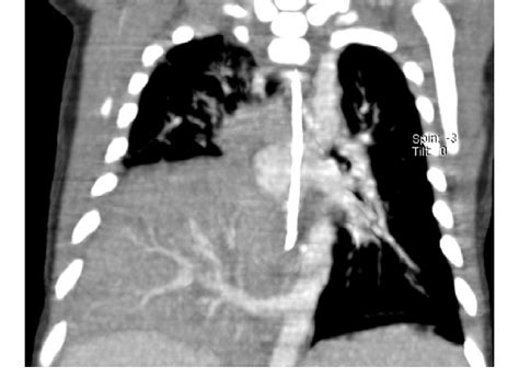 Pathology Diagnosis Bronchopulmonary Sequestration Radiological Download Scientific Diagram