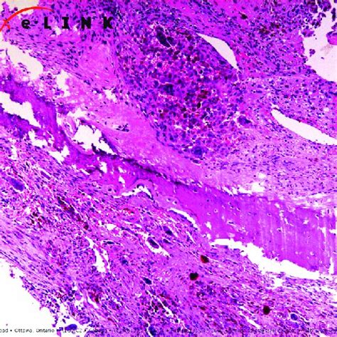 Giant Cells In Close Approximation To The Mandible Download