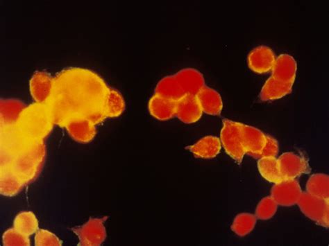 Non Vacciné Un Enfant Est Mort De La Rougeole En Italie