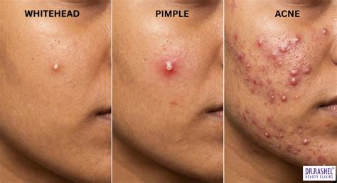 Acne Vs Pimples Vs Whiteheads Differences And How To Treat Drrashel