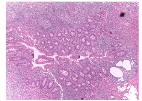Histopathological Examination Of The Appendix Without Pathological