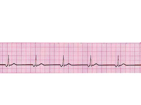 Mengenal Aritmia Yang Mengancam Atau Letal Aritmia Ppt
