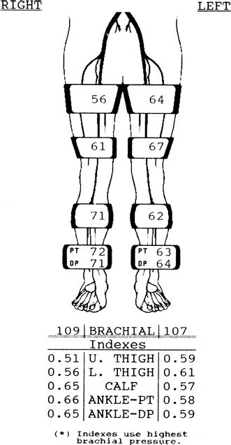 Segmental Doppler Pressures And Doppler Waveform Analysis In Peripheral Vascular Disease Of The