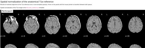 FMRIPrep Normalization Failed In A Problematic Subject Software