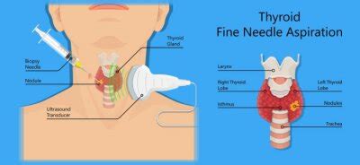 Thyroid Fine Needle Aspiration Biopsy Procedure Sample Tissue Posters