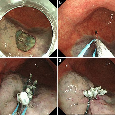 Endoscopic Closure Utilizing Endoloop And Endoclips A Esd Was