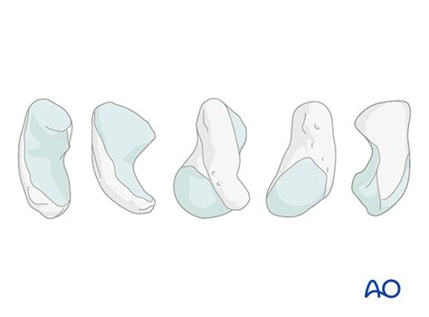 Orif Through Palmar Approach Retrograde Screw Fixation For Scaphoid Waist Fracture