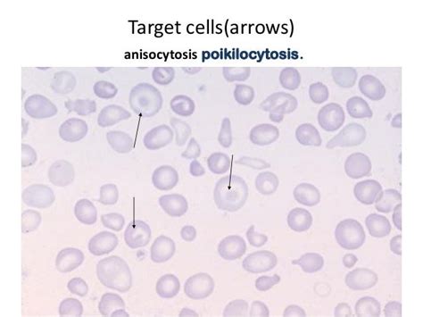 Pathology Of Hematolymphoid System