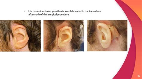Auricular Prosthesis Pptx