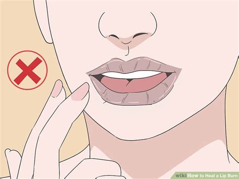Simple Ways To Heal A Lip Burn 9 Steps With Pictures Wikihow