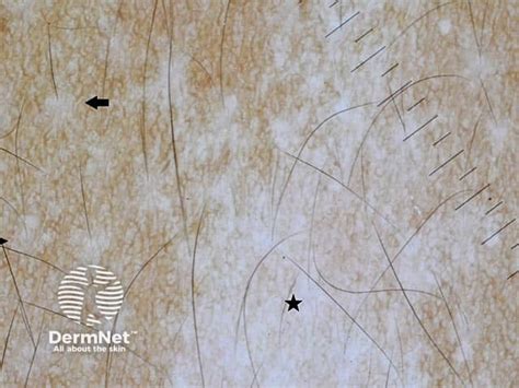 Segmental Pigmentation Disorder Images — Dermnet