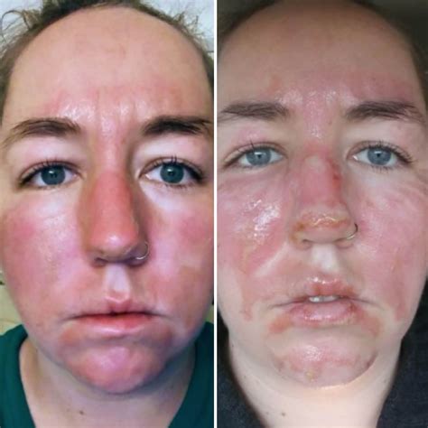 Face Burns After Applying Makeup Mugeek Vidalondon