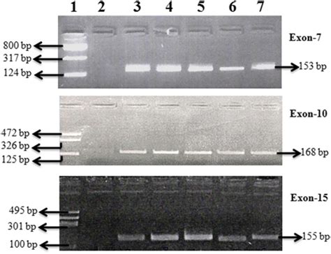 Molecular Investigation Of Fgfr3 Gene Mutation And Its Correlation With Clinicopathological