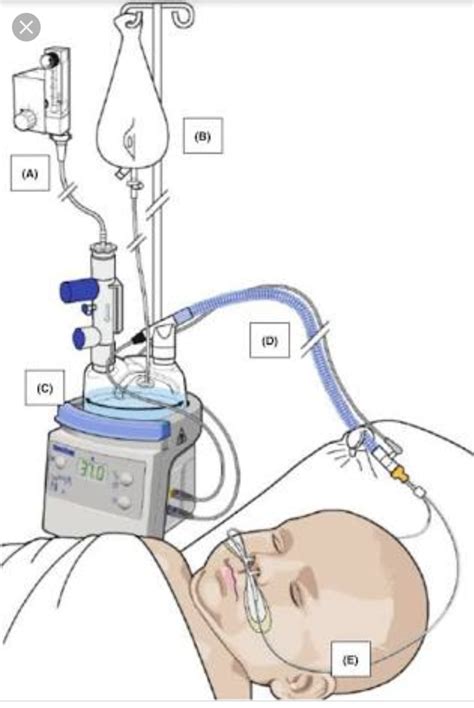 Hfnc Is An Effective Mode Of Indian Pediatrics