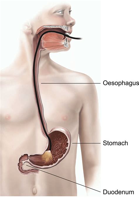 Endoscopy Meaning In Filipino At Marjorie Hiller Blog
