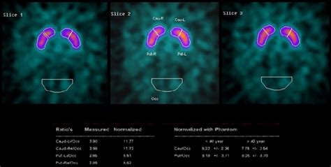 123 I Fp Cit Brain Spect Images With Semiquantitative Analysis From A Download Scientific