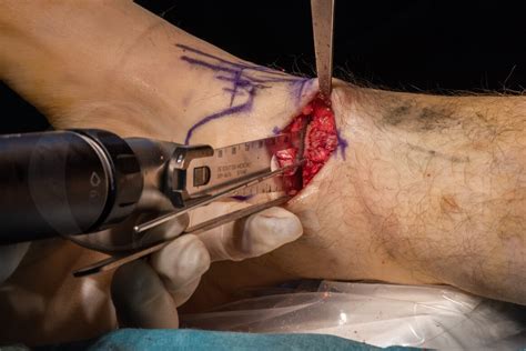 Supra Malleolar Distal Tibial Osteotomy Medial Closing Wedge Deltoid