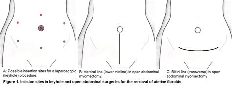 Laparoscopic Myomectomy Scars