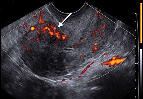 Uterine Cancer Ultrasound