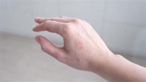Is There A Connection Between Pollen And Eczema Videos From The Weather Channel
