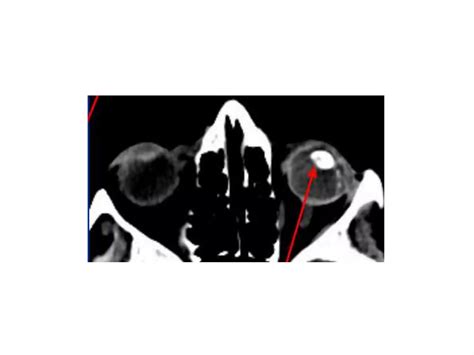 Orbital Calcification Pptx
