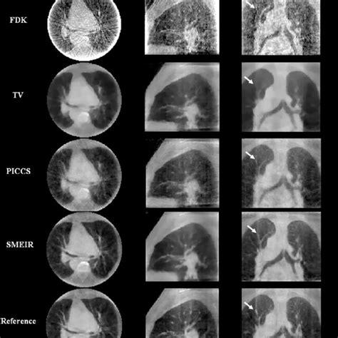 Pdf Clinical Evaluation Of A Novel 4d Cbct Reconstruction Scheme