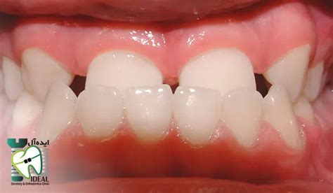 دلیل عقب بودن فک بالا چیست؟ راه درمان بدون جراحی یا با جراحی