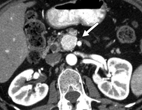 Pancreatic Imaging Mimics Part 2 Pancreatic Neuroendocrine Tumors And