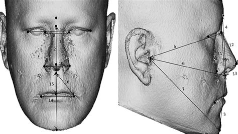 Figure 1 From Accuracy And Repeatability Of Anthropometric Facial Measurements Using Cone Beam