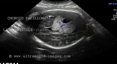 Choroid Plexus Ultrasound