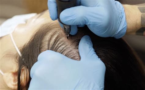 Scalp Micropigmentation By Billy Decola In Vancouver Bc Scalp Micropigmentation By Billy Decola In Vancouver Bc