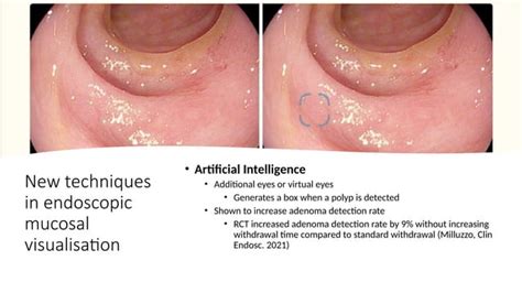 Colorectal Polyps Recognition Characterisation And Management Ppt