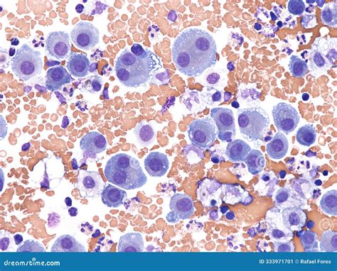 Mesothelial Cells In Pleural Fluid Stock Image Image Of Mesothelial Multinucleation 333971701