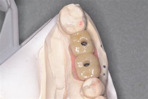 Implant Restorations In Berkeley Ca Dr Brian Assael Dds