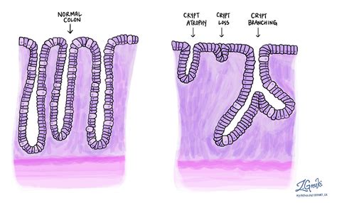 Chronic Active Colitis Mypathologyreport Ca