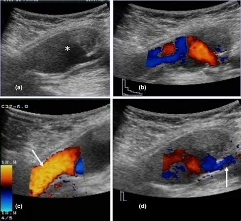 Pseudoaneurysms Different Ultrasound Patterns Aetiologies And Locations Pmc