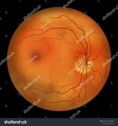Retina Neovascularization Over 76 Royalty Free Licensable Stock Illustrations And Drawings