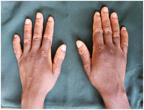 Layers Of Skin On Knuckle At Angeline Barron Blog