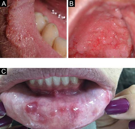 How To Remove Hpv Warts On Lips Reddit