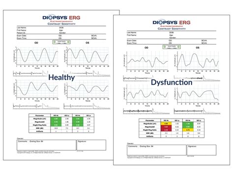 Office Based Pattern Electroretinography Perg Module Fabeyecare