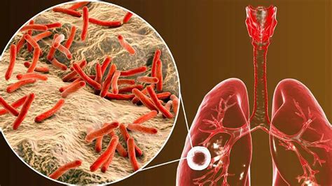 Tuberculosis Causas Síntomas Prevención Y Tratamiento