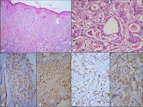 Photomicrographs From Scalp Excision Showing A Tumor Arranged In The