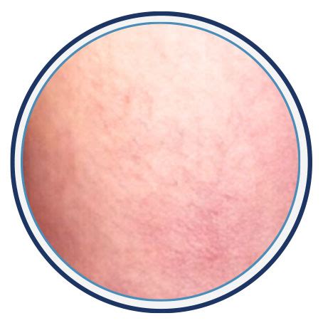 Sclerotherapy Sydney Vascular Surgeon