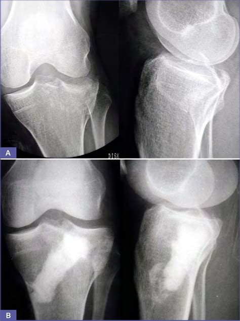 Bone Void Filler Of Metaphyseal Area After Arthroscopic Reduction Of
