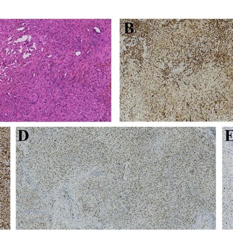 Figure E Unenhanced Ct Scan Showed Multiple Intrahepatic Lesions A
