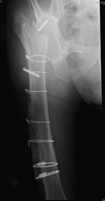 Radiograph Showing The Right Hip After The Excisional Arthroplasty In Download Scientific
